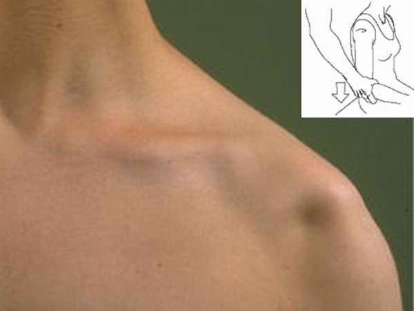Multidirectional Shoulder Instability (MDI) - Shoulder & Elbow - Orthobullets